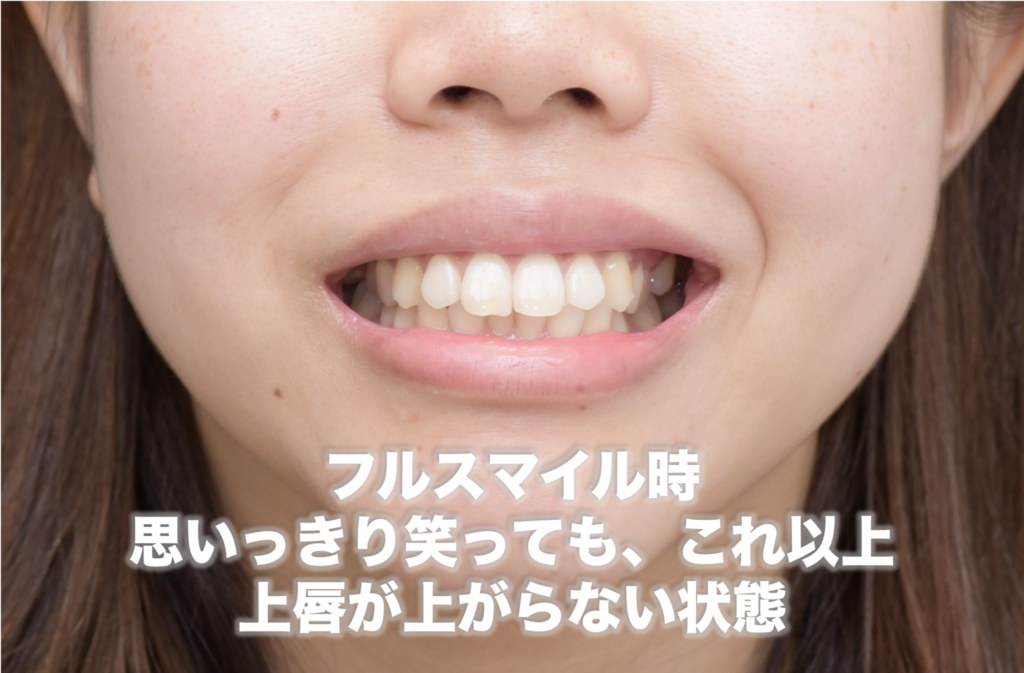笑うと10mmの歯茎の露出がある重度ガミースマイルを治療した症例(上唇粘膜切除術)|天王寺区(四天王寺前夕陽ヶ丘)の歯医者「ヤスデンタルクリニック」