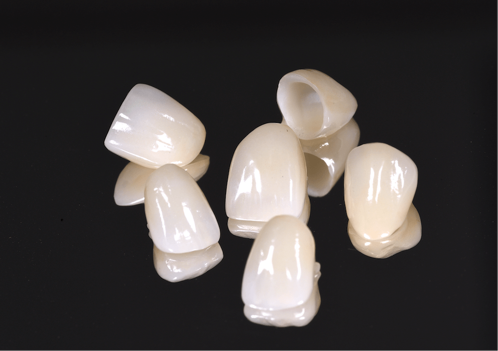 前歯6本のセラミック治療の費用はどれくらい？ | 大阪でセラミック矯正をするなら「ヤスデンタルクリニック」